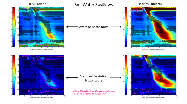 Advantages of Isocontour Analysis – Manometry Databank