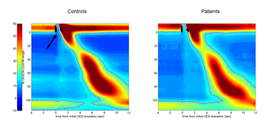 Symptomatic Patients with “Normal” Esophageal Manometry – Manometry ...